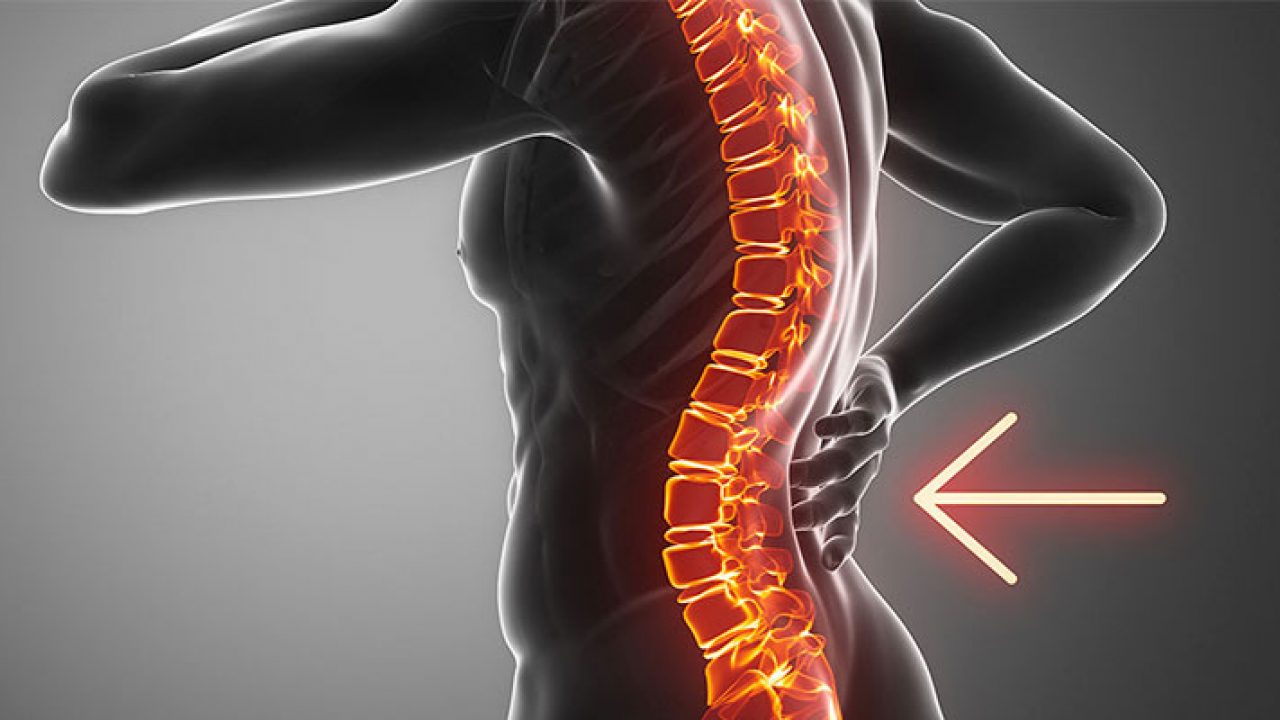 Hiperlordose da Coluna - Sintomas e Tratamento - Dr. Vinicius Sabag